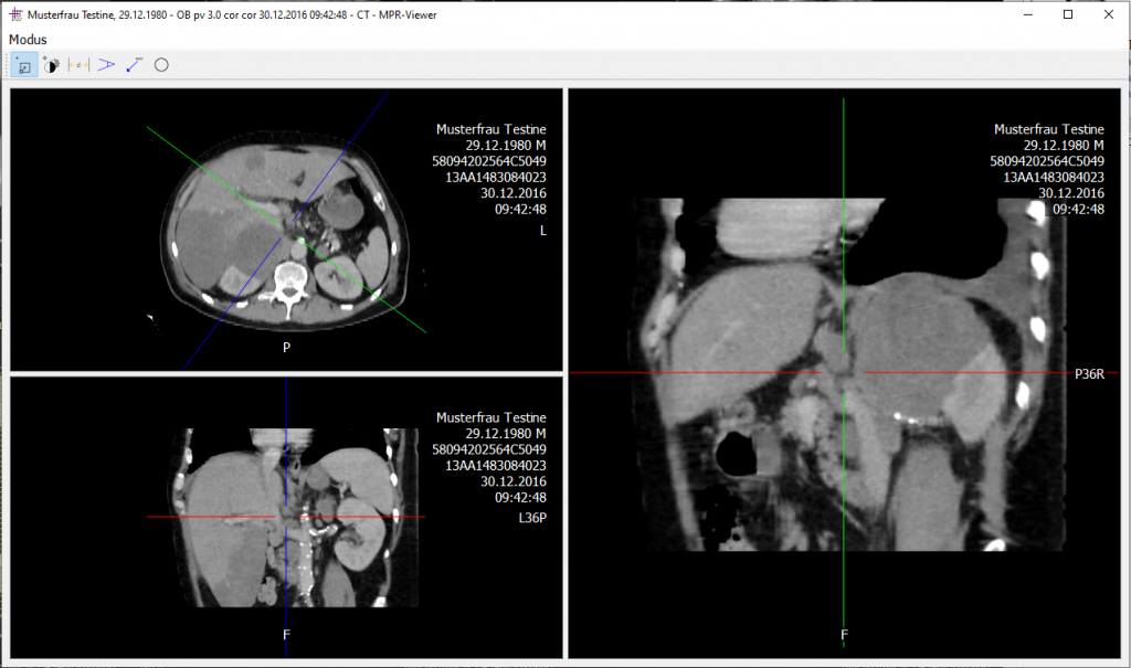 Multiplanare Reformatierung (MPR) - STARC medical